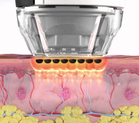 What does EMatrix Help With? – Satori Laser